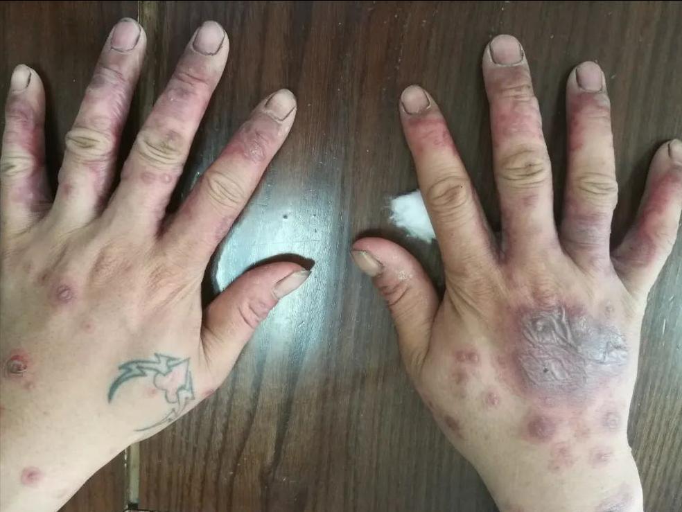 Generalized erythema multiforme, how to cause it? - iNEWS