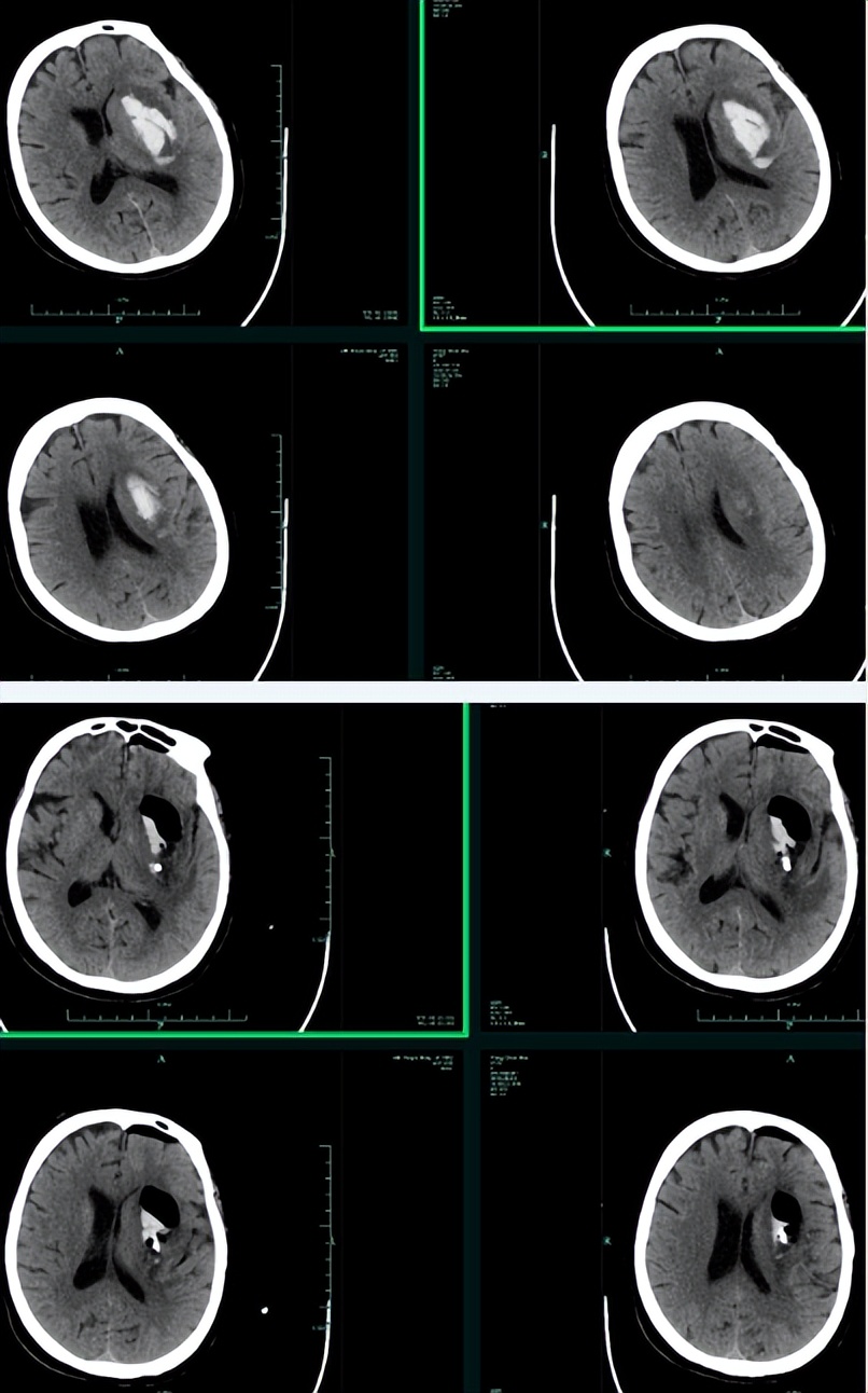 Minimally invasive treatment of cerebral hemorrhage, reducing trauma ...