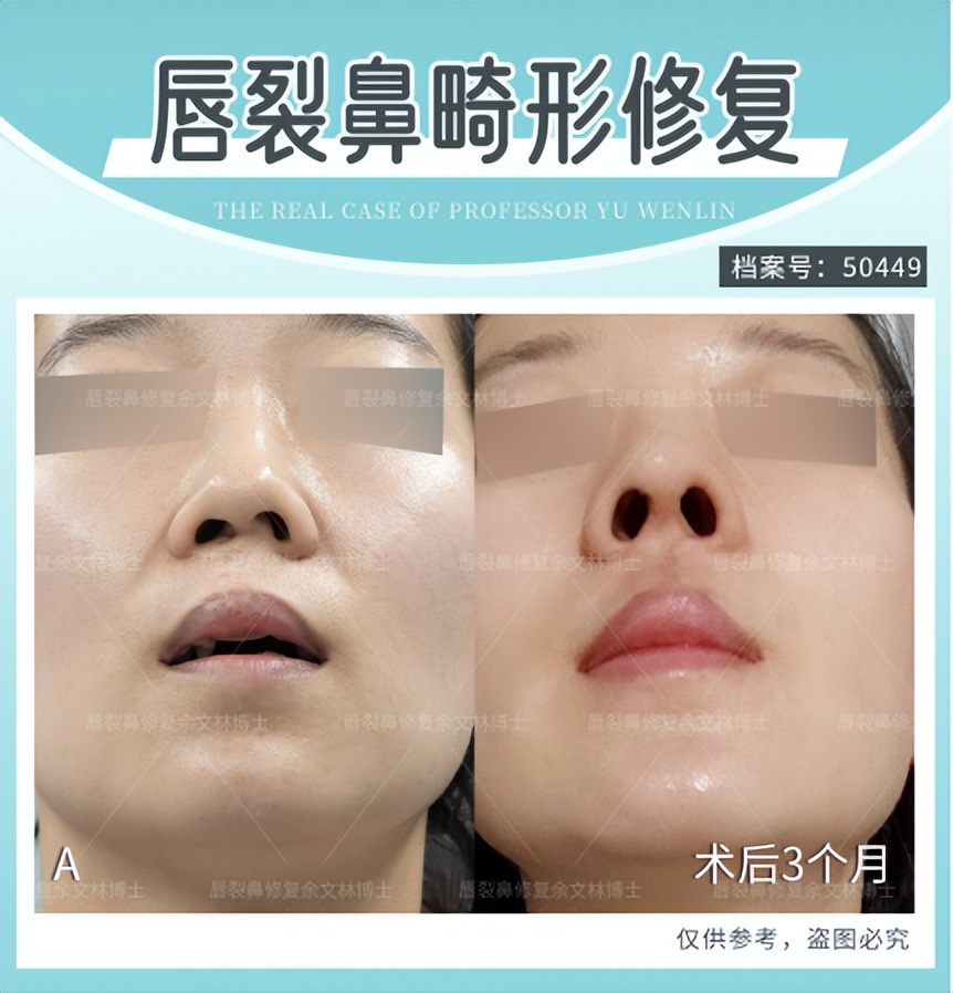 How does the wound change after cleft lip surgery, and how can the scar ...