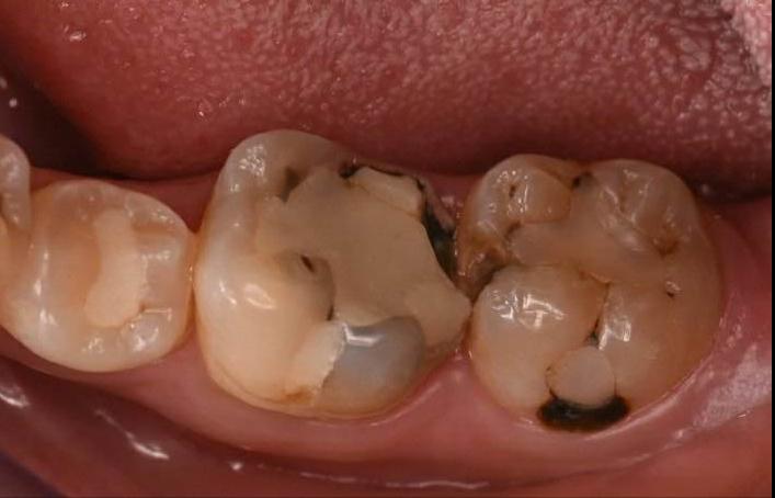 Why do you need to drill holes in your teeth after rotten teeth?Dental ...