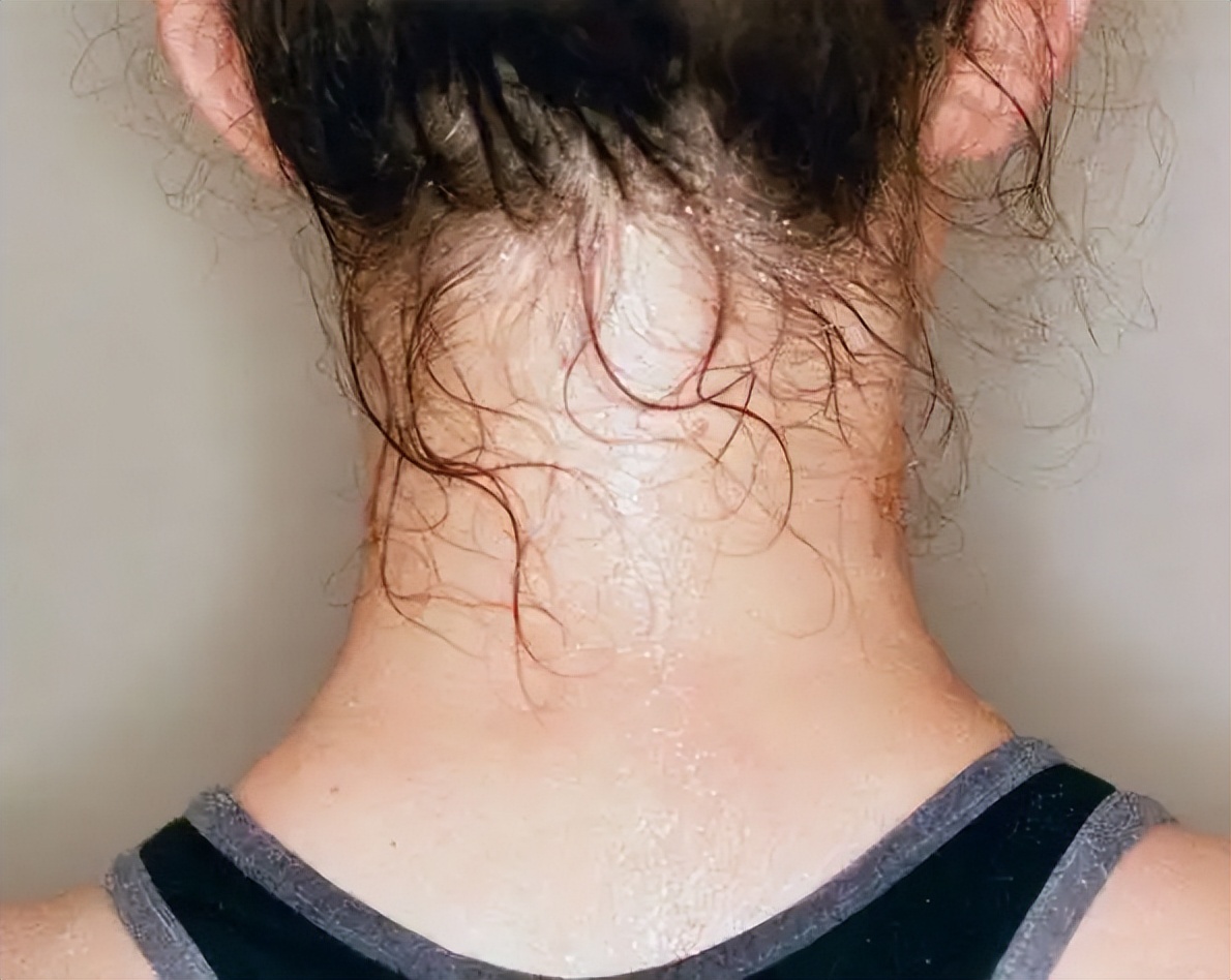 Sweating in this part is actually a precursor to a stroke! (quickly ...