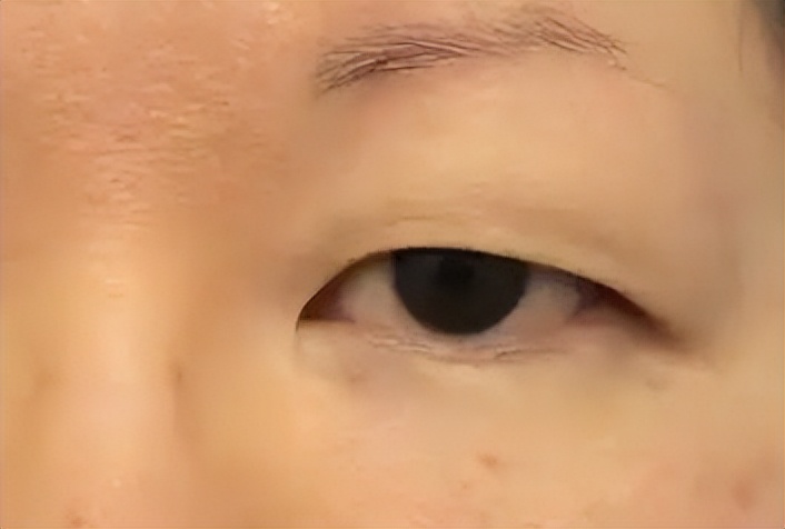 Droopy eyelids look 10 years older!How to choose eyebrow lift and ...