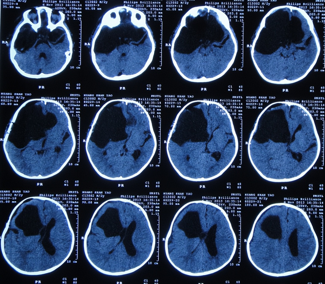 Hydrocephalus coma caused by ventriculoscopic surgery for giant ...