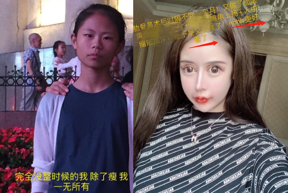 Zhou Chuna: She had plastic surgery at the age of 13 and spent 4 ...