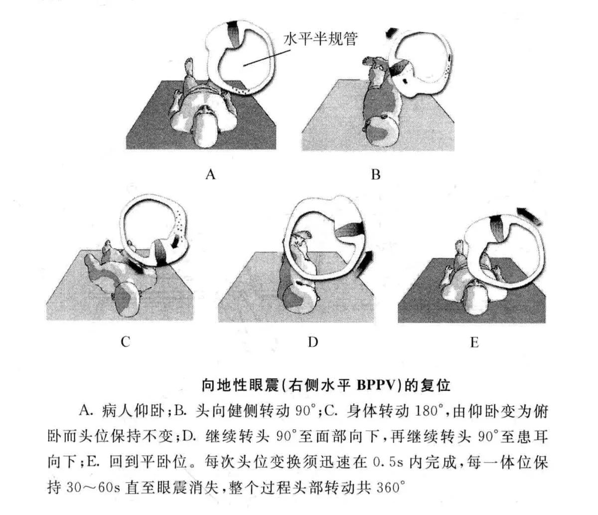 Benign paroxysmal positional vertigo - iNEWS