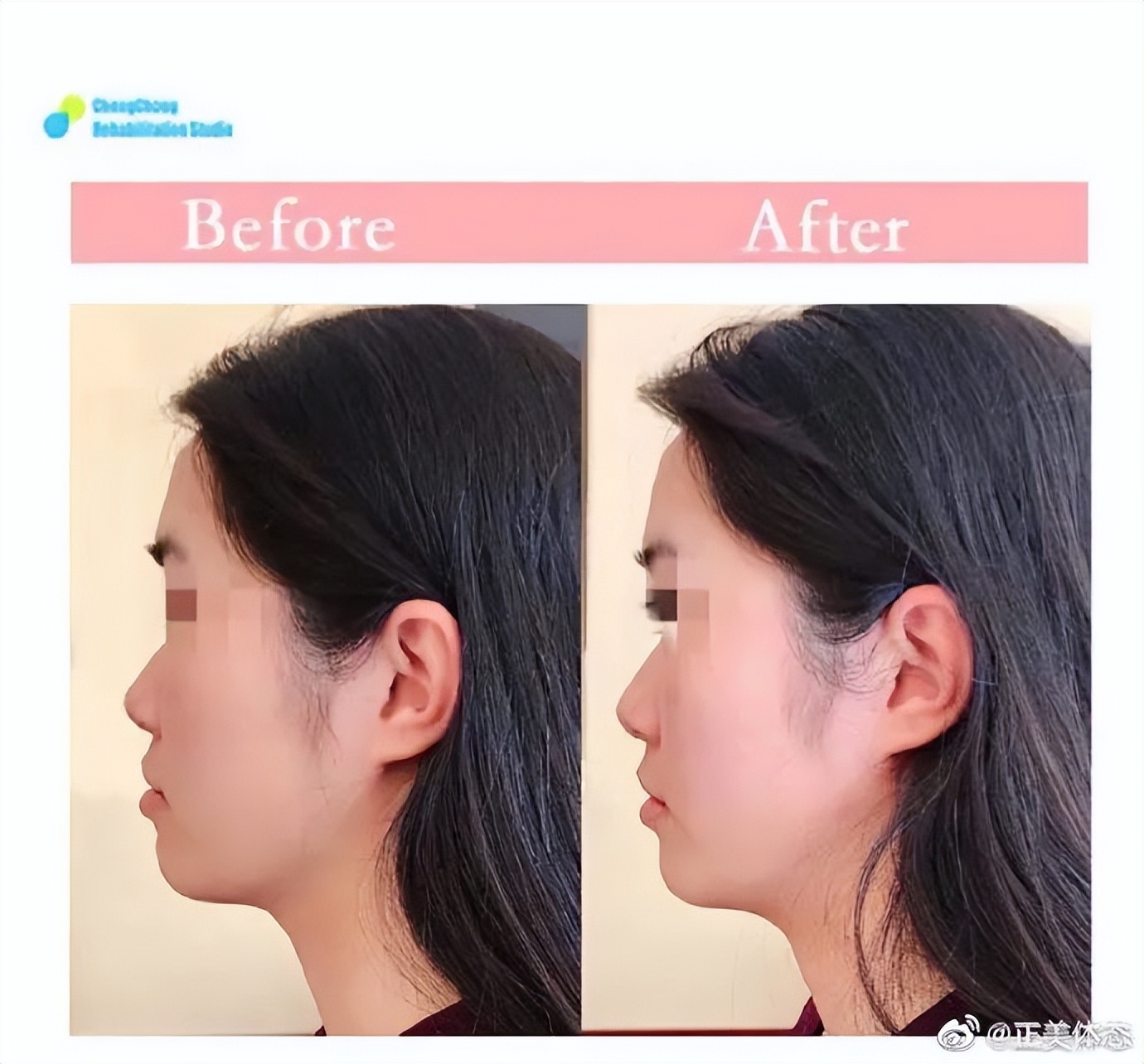 The face looks old and rustic! "Nose base depression + moon face" - iMedia