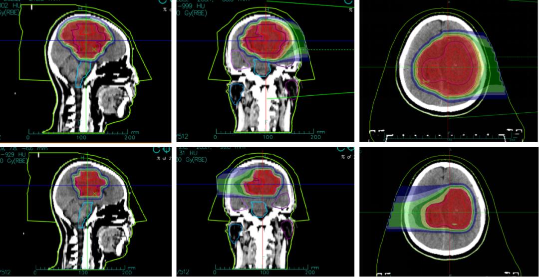 Follow-up for 30 months after carbon ion therapy for glioma - iNEWS