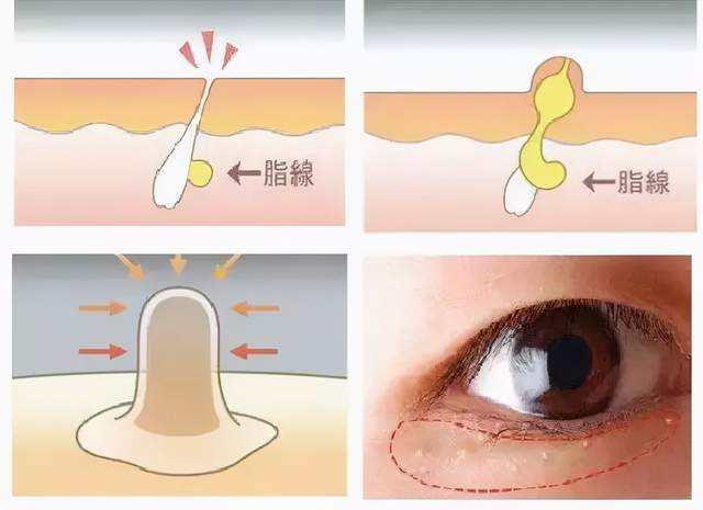 How to tell if it's fat granules or acne? - iNEWS