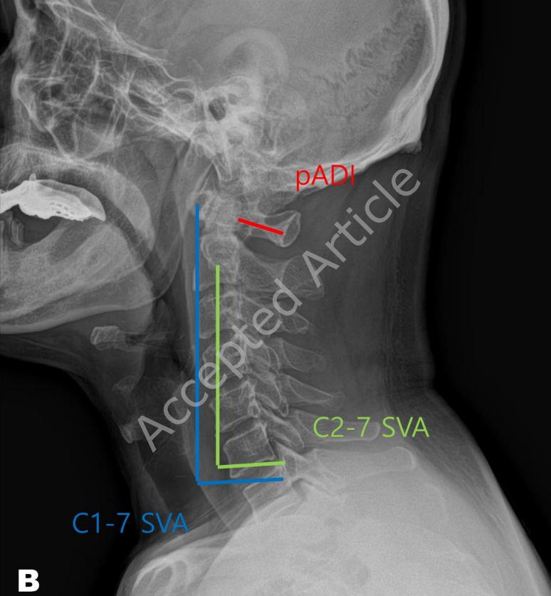Radiological parameters and clinical outcomes after C1-2 posterior ...