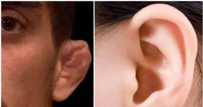 Wrestlers train injured ears to become "dumpling ears": it's an honor ...
