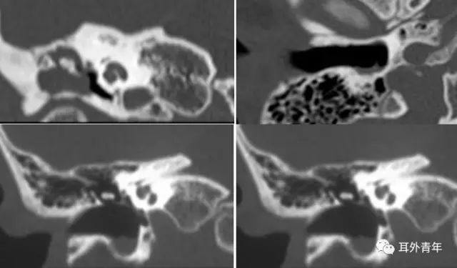Common Abnormal Temporal Bone CT Summary - iNEWS