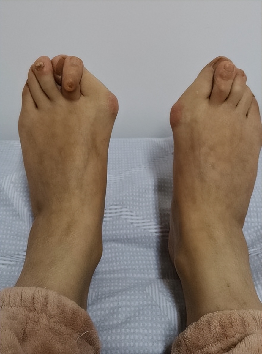 Hallux valgus combined with overlapping toes deformity, which has a lot to do with the length of ...