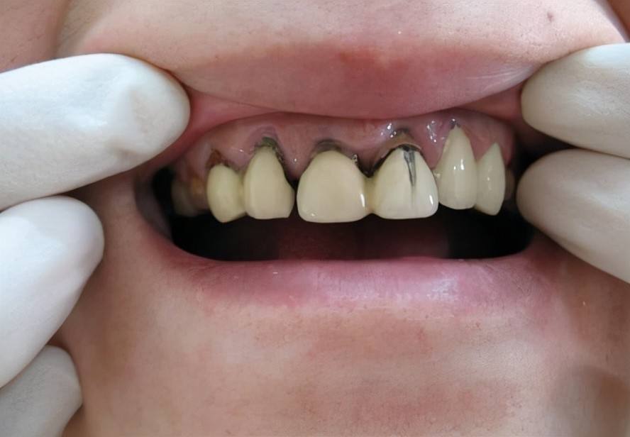 What is the disease of black gums!Reminder: these things need to be ...