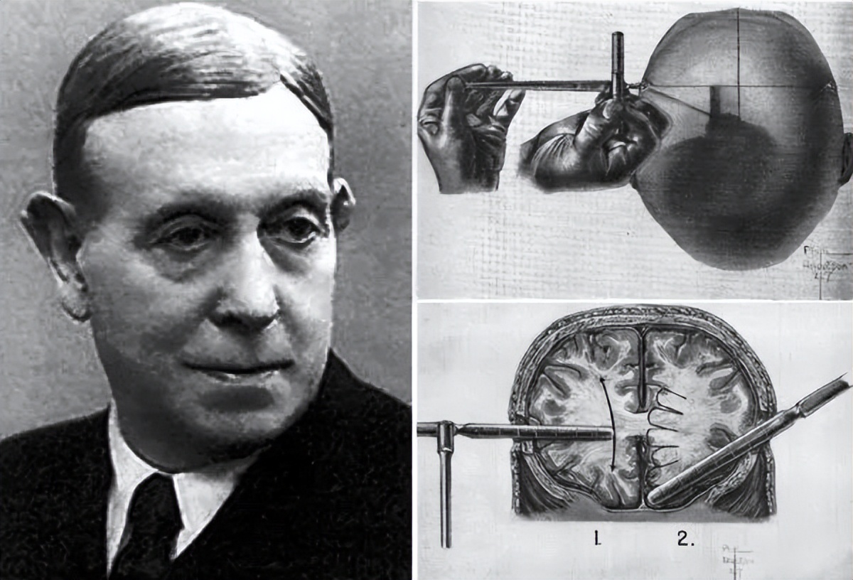 The "Black History" of the Nobel Prize: Frontal Lobotomy - iNEWS