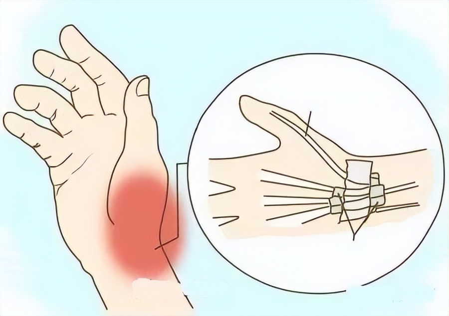 How can the mobile phone family stay away from tenosynovitis? - iNEWS
