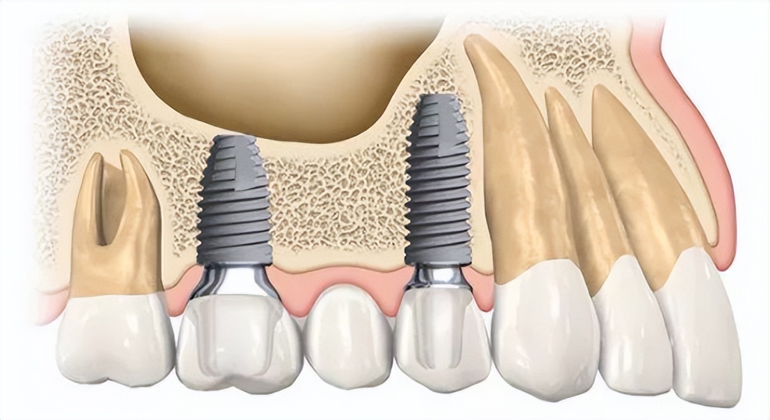 Five years of dental implant experience sharing, do not violate the ...