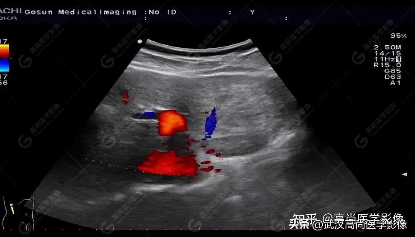 Liver function was normal, and color ultrasound revealed cirrhosis ...