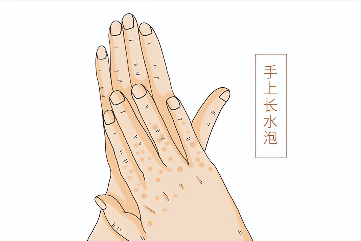 Small blisters always grow between your fingers, itchy and want to ...