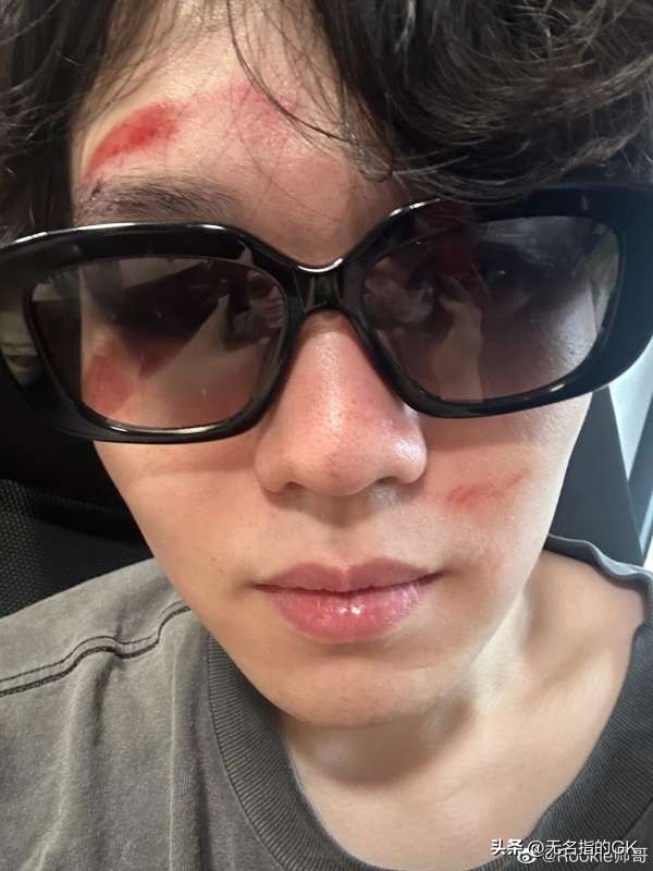 Rookie shared facial photos after walking the stairs to watch her ...