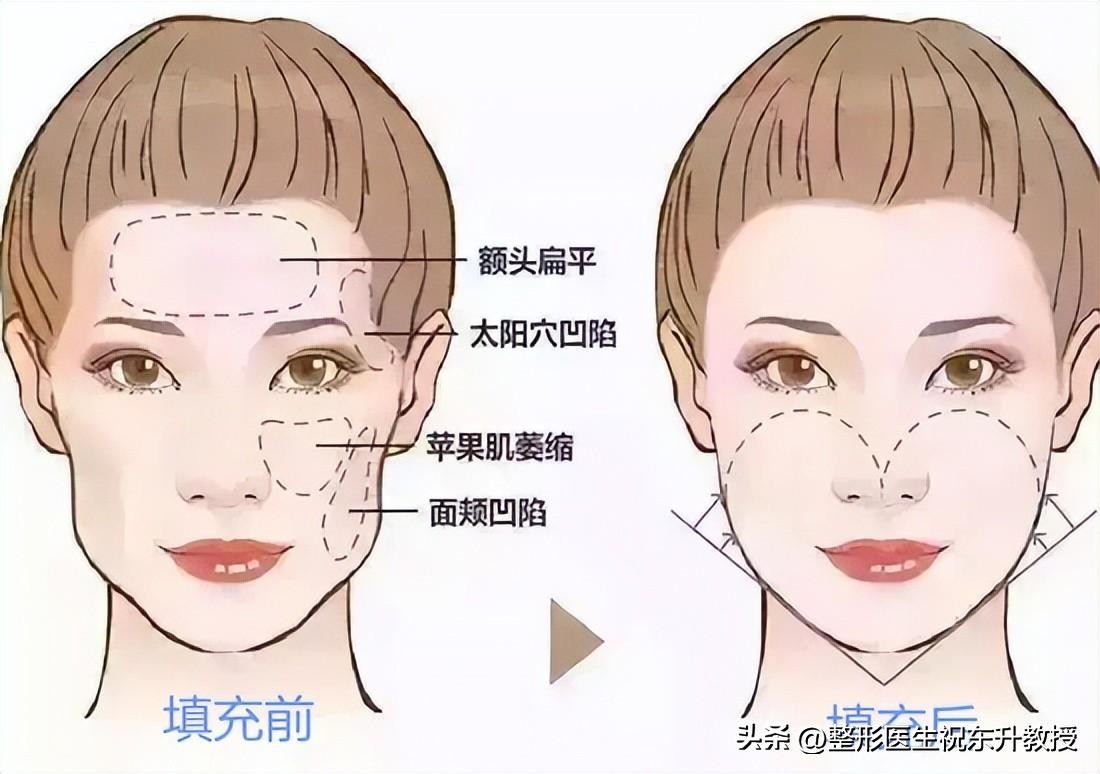 A full face makes you look younger!15-day real record of autologous fat ...