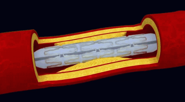 Will the installation of a heart stent affect the human body?How do you ...