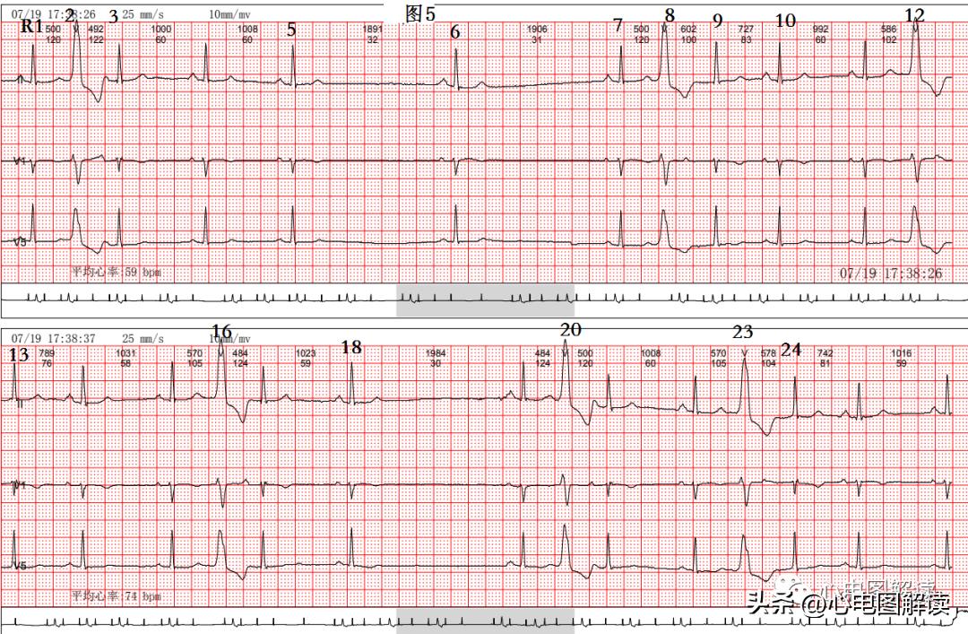Sinus arrest?Sinus block? - iNEWS