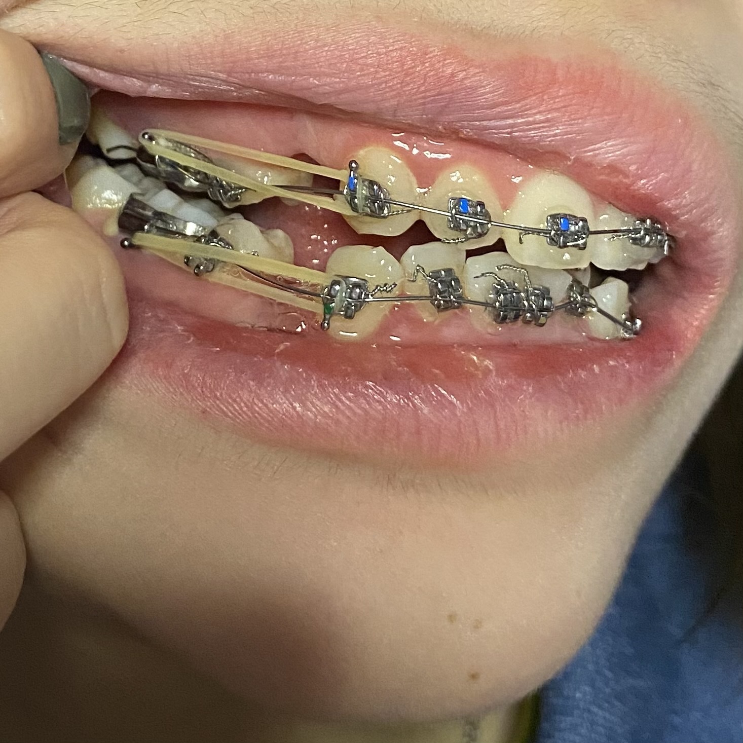Orthodontic science-how long do you usually wear braces with rubber ...