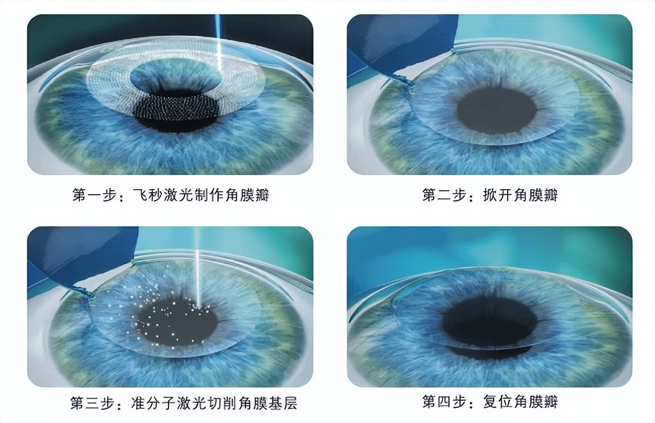 How to choose myopia surgery?Super detailed comparison of the four ...