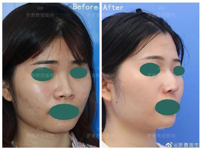 Large nostrils + wide nose wings + collapsed nose bridge - iNEWS