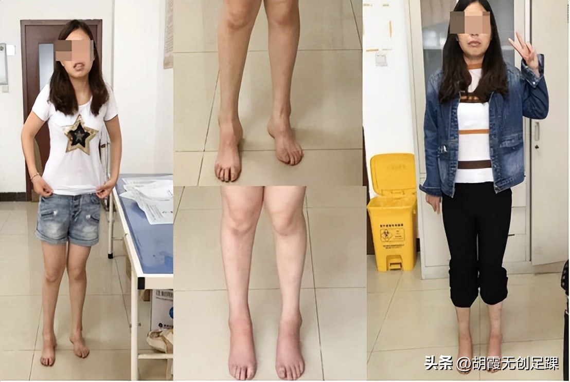 Non-invasive correction technology of foot and ankle - the choice of ...