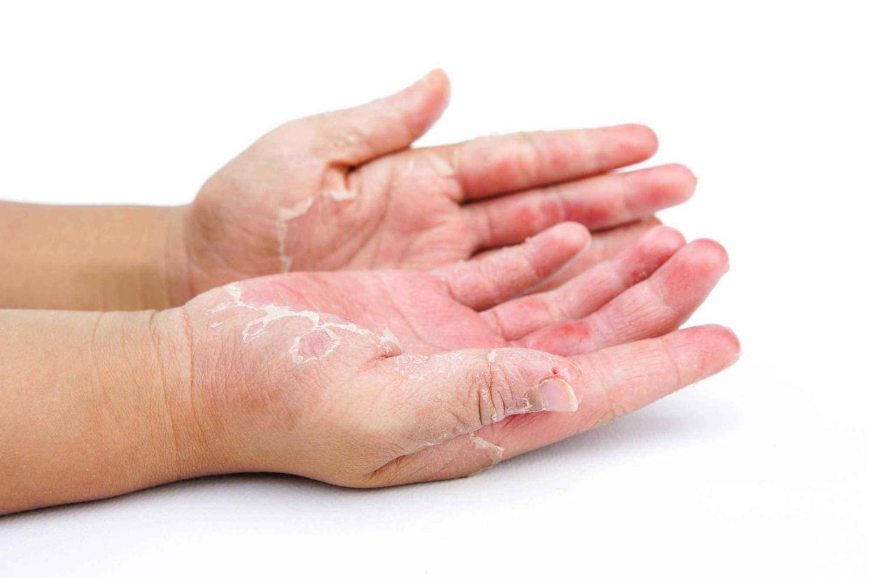 What causes peeling skin and ringworm on hands and feet?How to treat ...