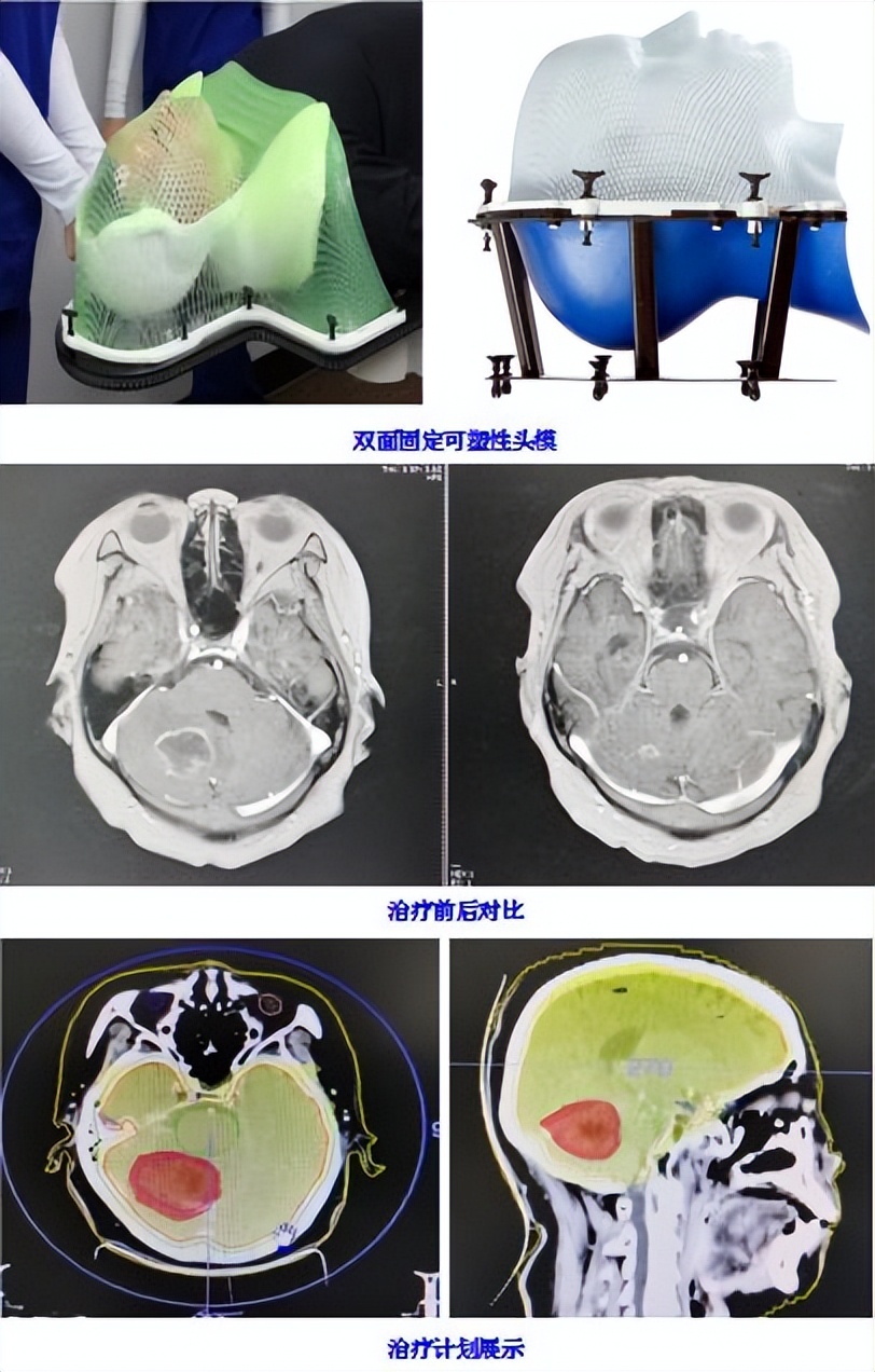 New options for brain metastases: precision radiotherapy for brain ...