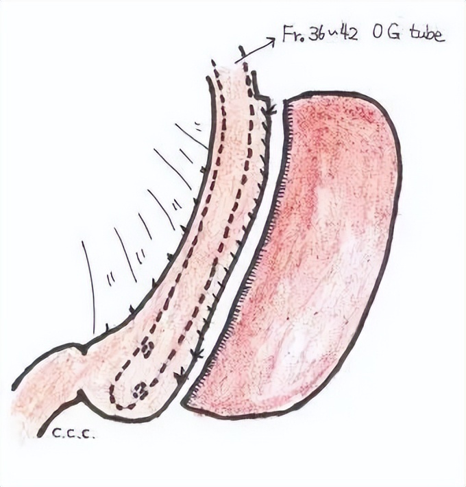 How Metabolic Bariatric Surgery Says Goodbye to Fat - iNEWS
