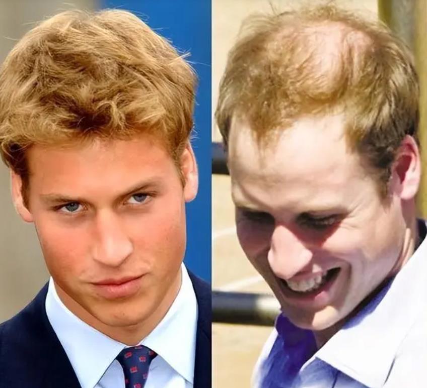 "Baldness" in the entertainment industry is a disaster, but why did the ...