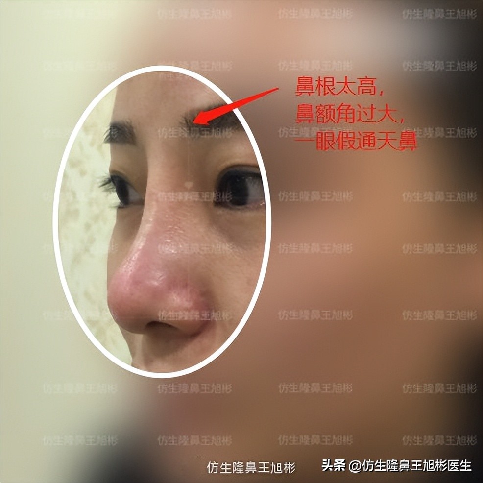 Why do some noses look straight?Demystifying 3 manifestations of ...