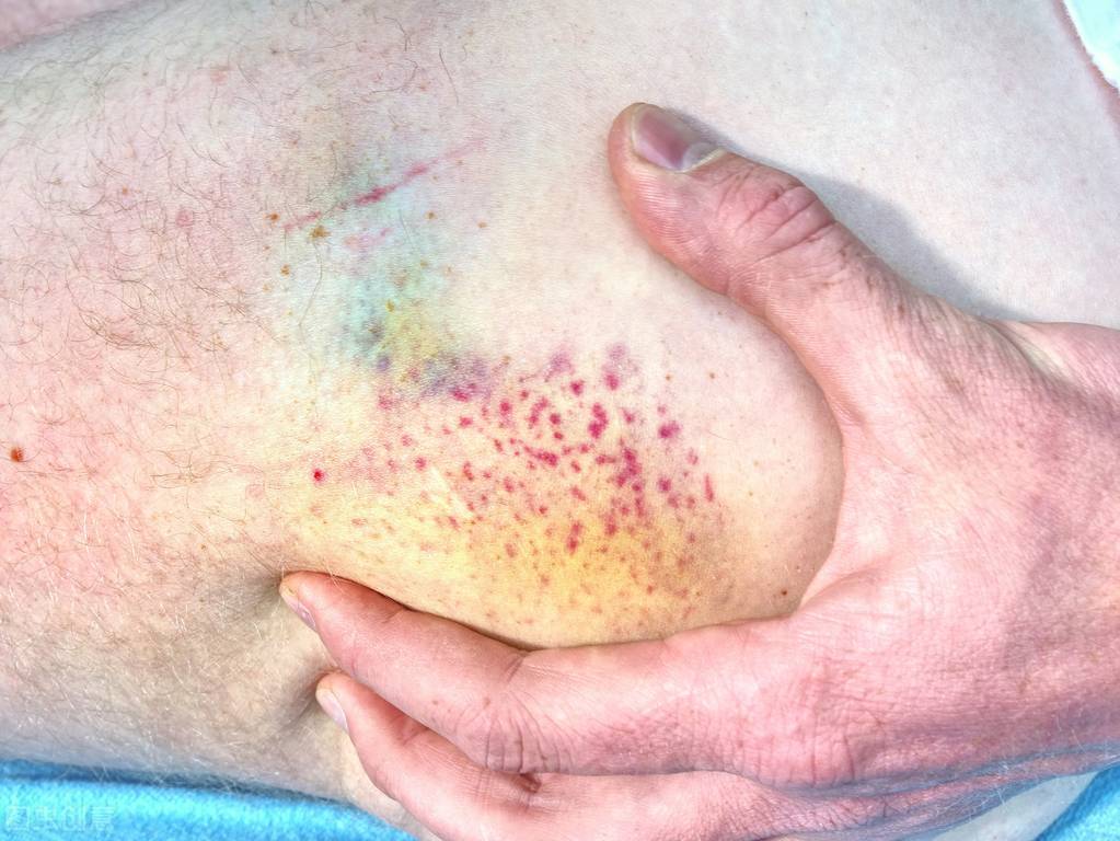 What is thrombocytopenic purpura?A quick understanding of the article ...