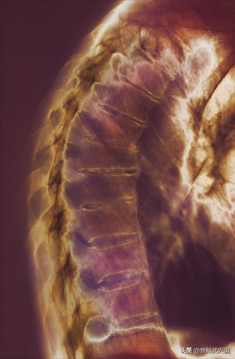 What happens to people with ankylosing spondylitis? - iNEWS