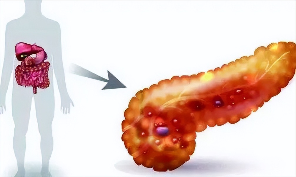 If it is serious, it will be fatal, "pancreas" must be careful - iNEWS