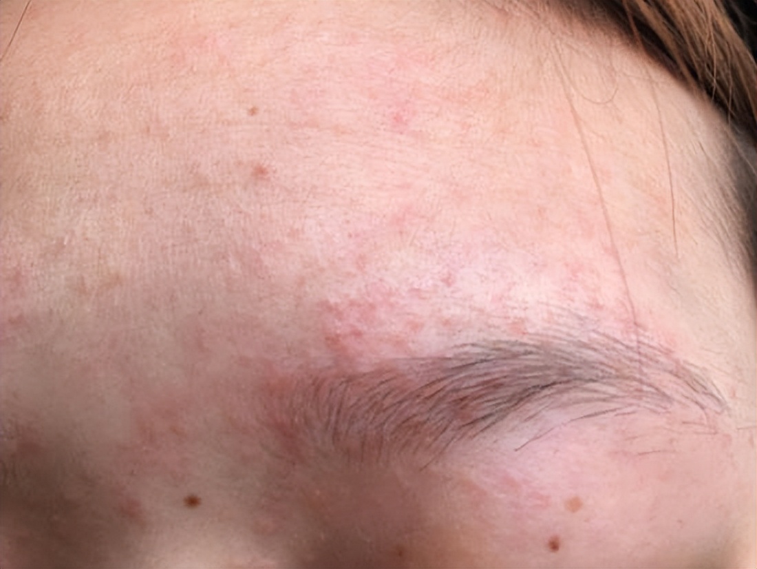 Cicada acne treatment: what to do if there are mite acne on the face ...