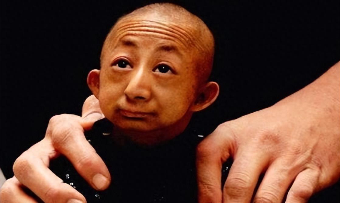 He Pingping, the "world's number one dwarf", passed away suddenly 10 ...