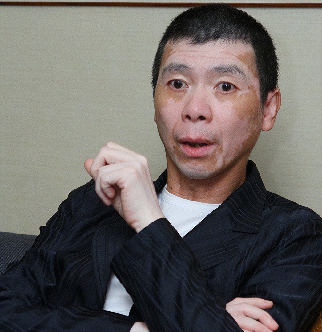 Feng Xiaogang responded that Vitiligo was cured! In the photo with Ge ...