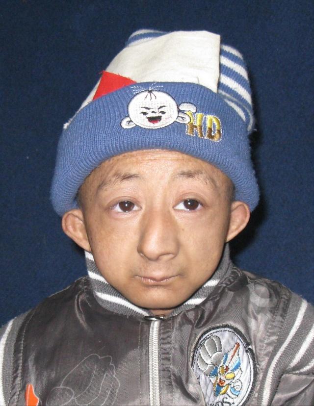 He Pingping: He became "the world's first dwarf" at the age of 19, died ...