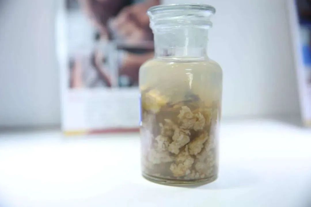 Tophi actually squeezed by hand?the risk is too great for you to bear - iNEWS