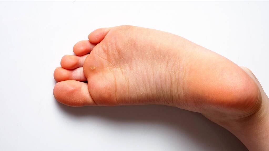 What's the matter with calluses on the soles of the feet and pain when ...