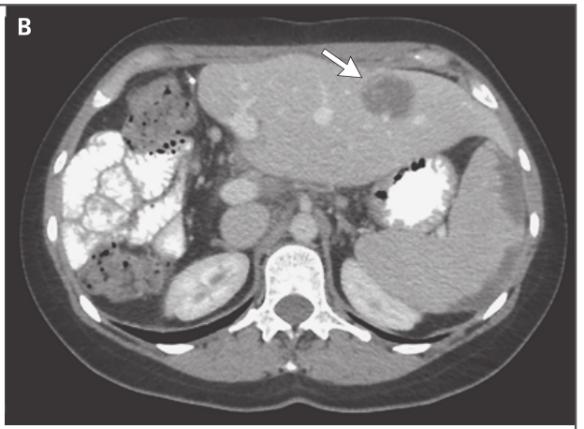 After 4 years of fighting cancer, she relapsed many times. After she ...