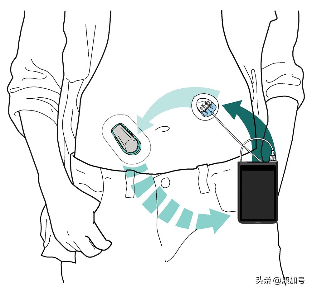 A wearable 'bionic pancreas' automatically improves blood sugar control ...