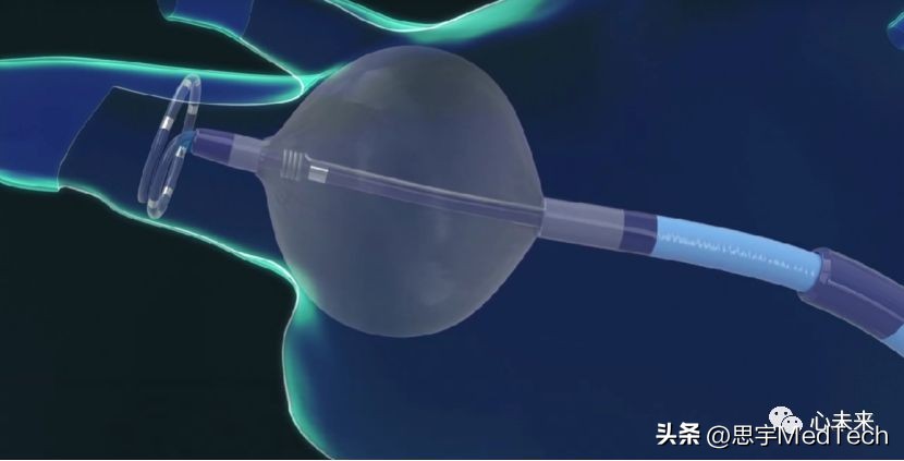 Approved CE! Poco Cryoablation Balloon - iMedia