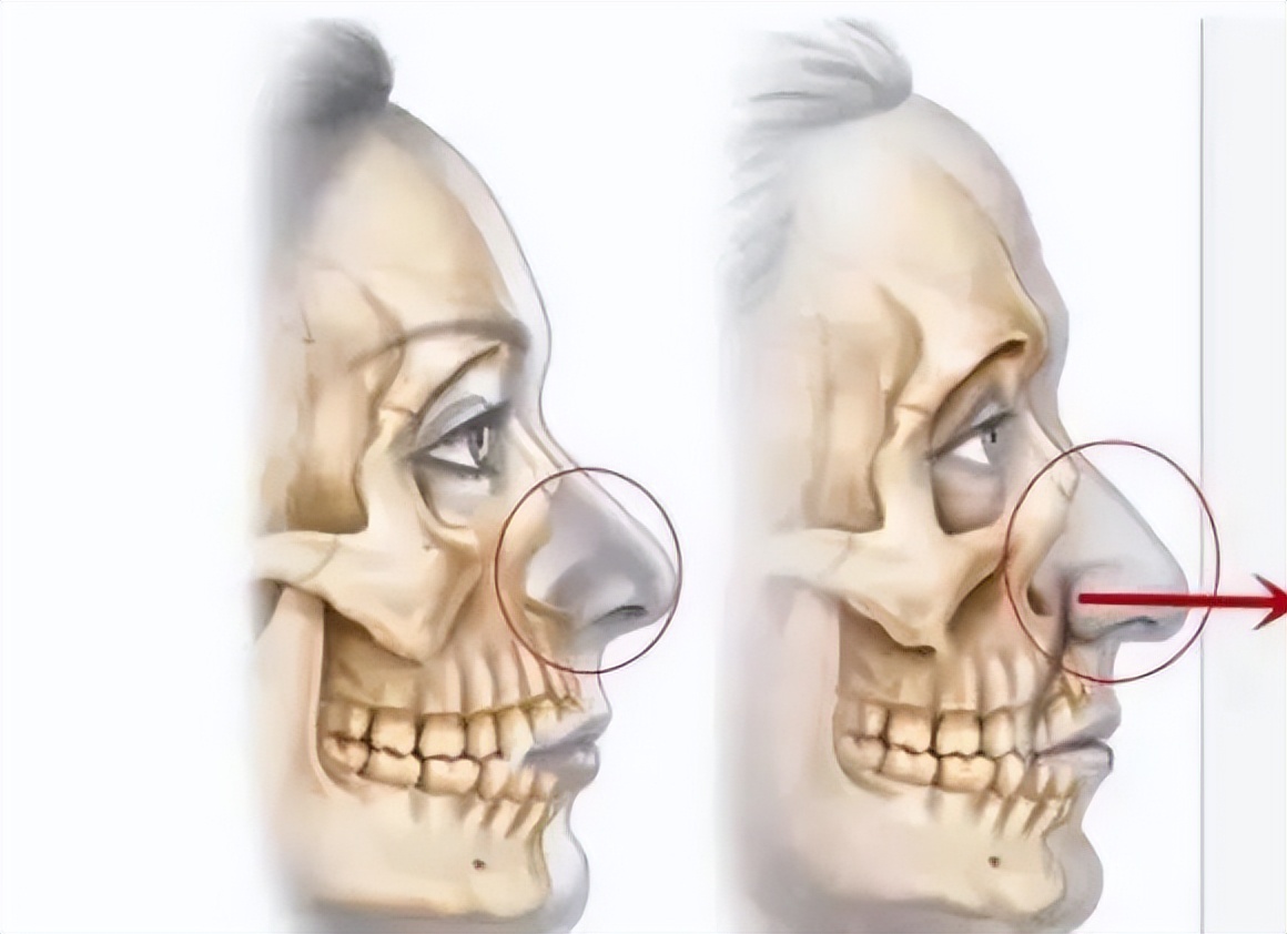 The face looks old and rustic! "Nose base depression + moon face" - iMedia