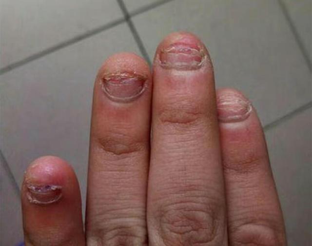 Is the child's love of chewing nails a lack of vitamins?Not necessarily ...