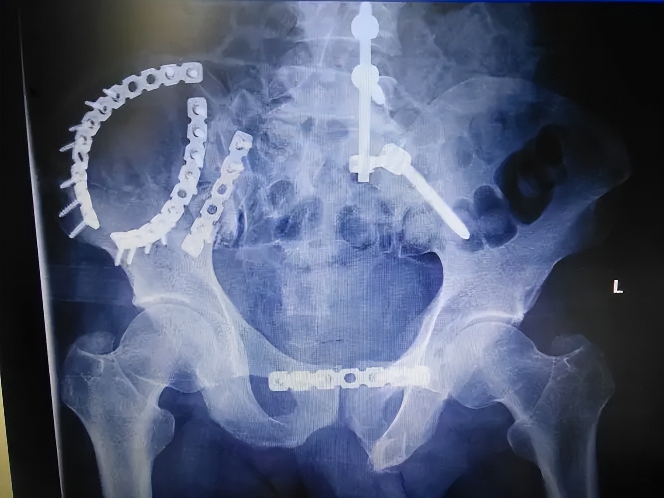After posterior pelvic ring injury, what are the advantages of ...
